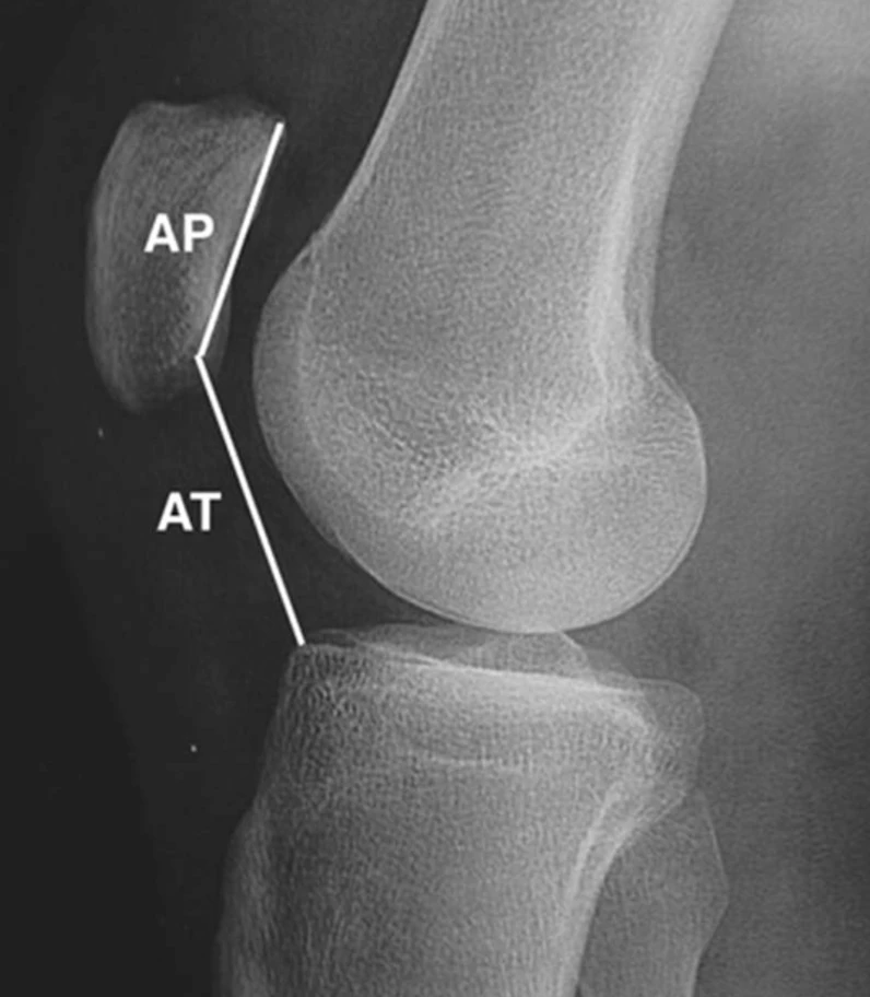 Prise en charge conservatrice de l’instabilité rotulienne - NeuroXtrain