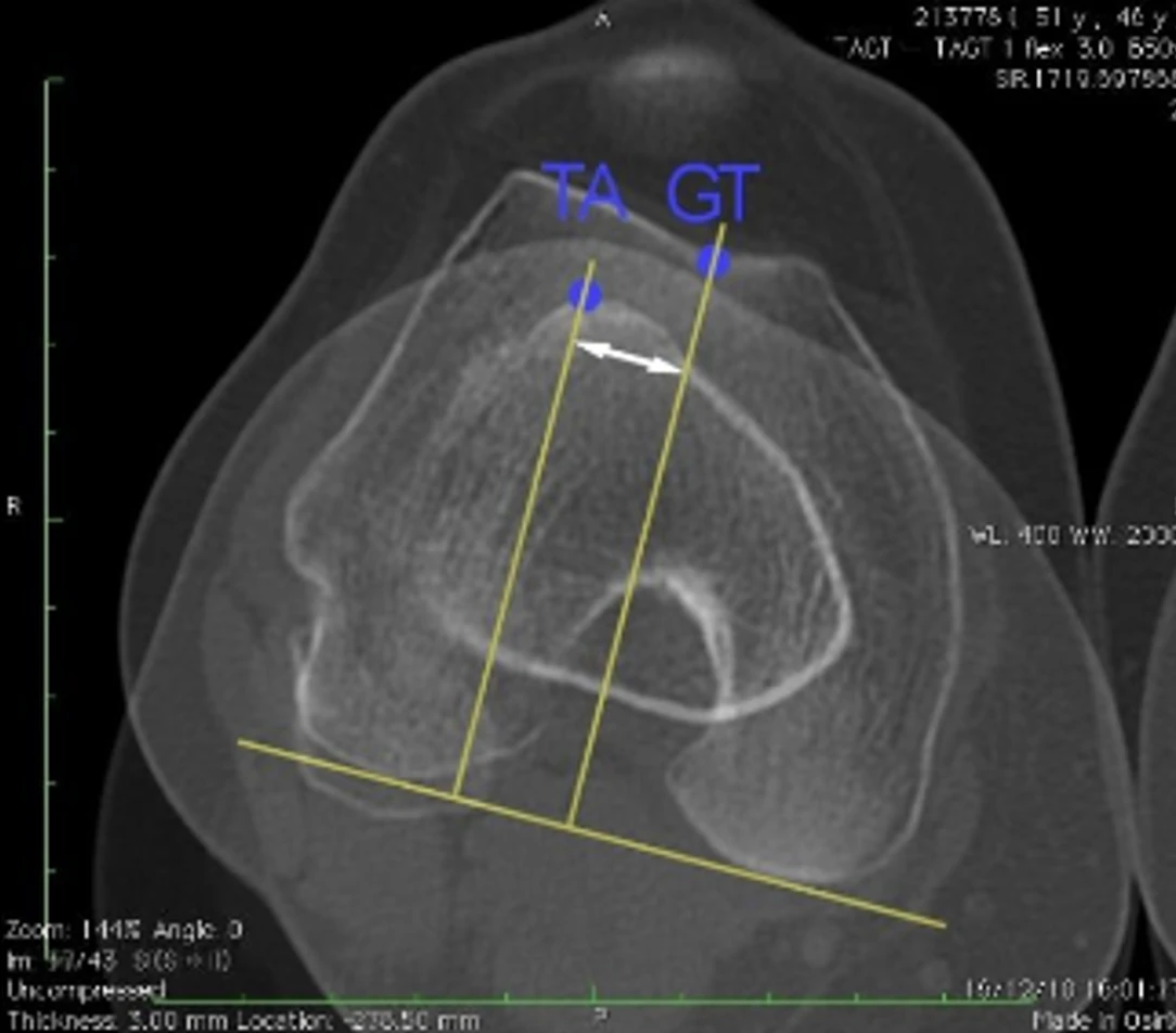Prise en charge conservatrice de l’instabilité rotulienne - NeuroXtrain