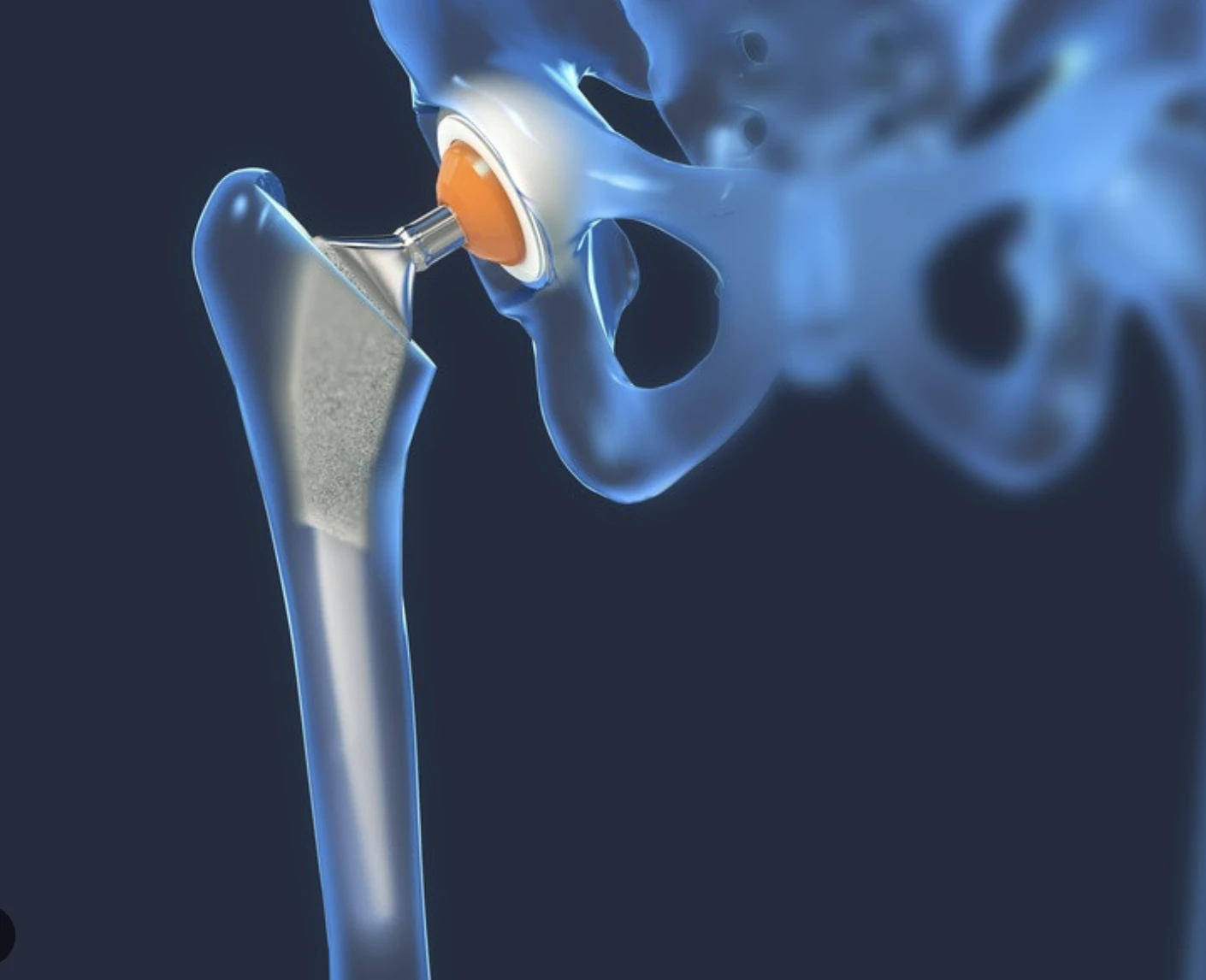 OXFORD HIP SCORE (OHS) - NeuroXtrain